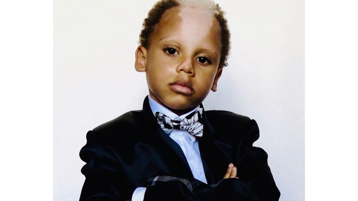 Conheça o modelo Samuel, que nasceu com condição rara na pele e ...